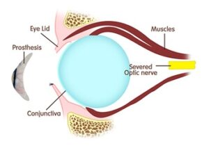 Ocular Prosthetic Services in Dubai | Imperial Health